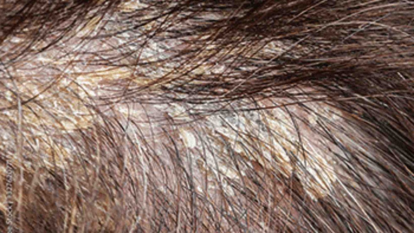 Dermatitis | Vrste dermatitisa i rešenja