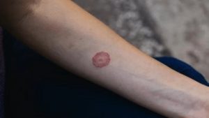 Lišaj na koži | Što je to? Simptomi i znaci!