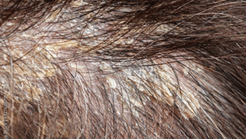 Dermatitis | Types of dermatitis