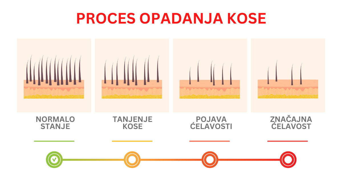 Alopecija i opadanje kose | Uzroci, Simptomi i učinkoviti lijekovi